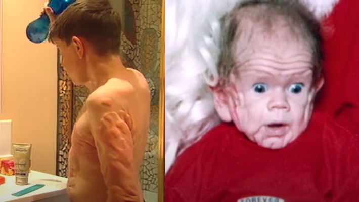 The unique baby born with enough skin for a five-year-old child