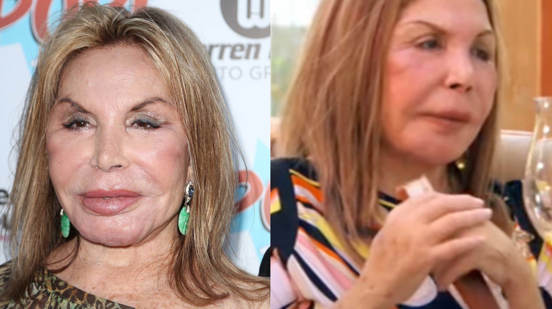 The plastic surgeon who worked on Elsa Patton’s face “ruined” it ...