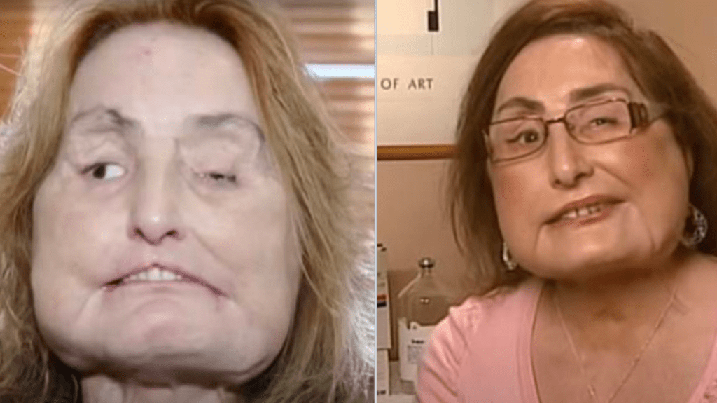 Connie Culp was the first face transplant patient in the United States ...